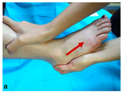 Back to Basics: Evidence-Based Treatment for Ankle Sprains – sapiens movēs